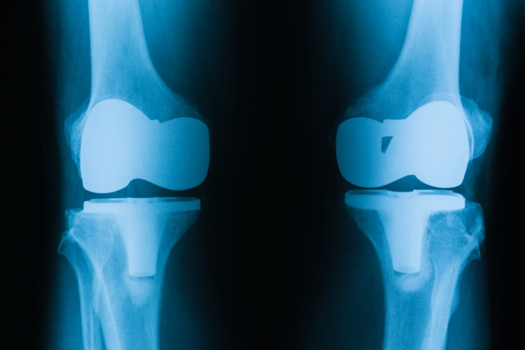 Orthopedic Analysis | ADVANCED IMMUNOLOGICAL TESTING LAB